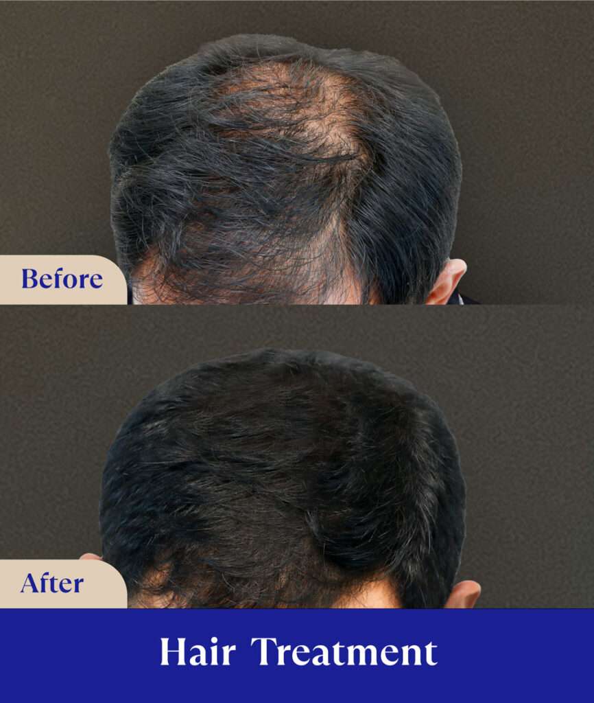 Hair Treatment, Penumbuh Rambut dan Perawatan Rambut Rontok